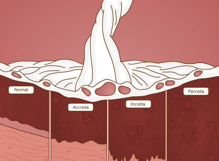 Antenatal Ultrasound Diagnosis of Placenta Accreta Spectrum Disorder ...